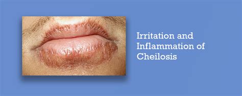 Cheilosis Causes Symptoms And Treatment Carifree