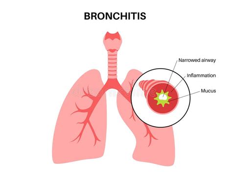 Bronchitis Lung Disease Stock Vector Illustration Of Pulmonary 275132855