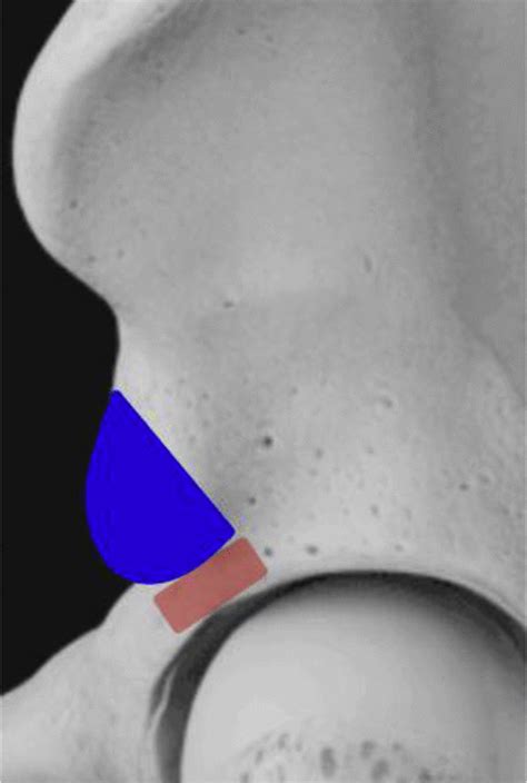Arthroscopic Decompression Of A Type Iii Subspine Impingement Pmc
