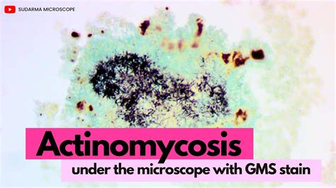 Actinomycosis Under The Microscope With Gomoris Methenamine Silver