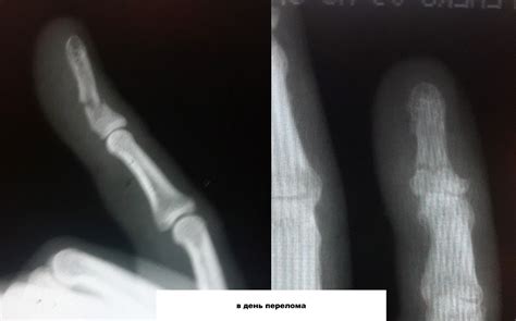 Шпора На Пальце Фото Рентген — Картинки фотографии