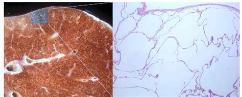 Panlobular Emphysema From 1 Antitrypsin Deficiency This