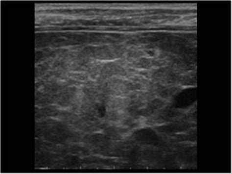 Abdomen And Retroperitoneum Liver Case Miscellaneous Liver Ultrasound Cases
