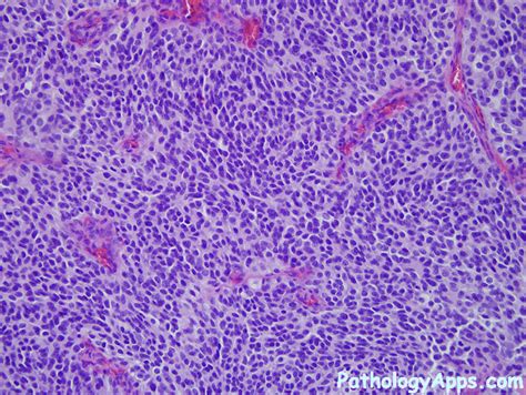 Esthesioneuroblastoma Histology