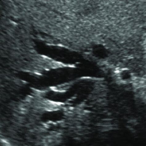 Ultrasonography Showing Dilated Intra Hepatic Ducts With Echogenic Download Scientific Diagram