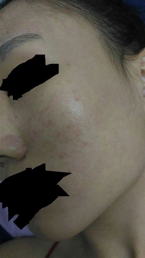 Papulopustular Rosacea Or Normal Acne Or Seborrheic Dermatitis
