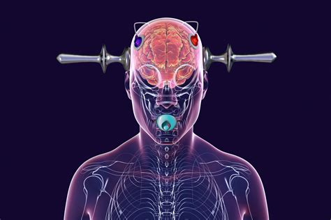 Ect Outcomes In Depression Does Seizure Length Matter Major