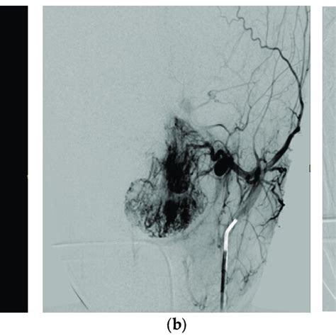 An 8 Year Old Female With An Extensive Avm Avm Is Shown On Cta A