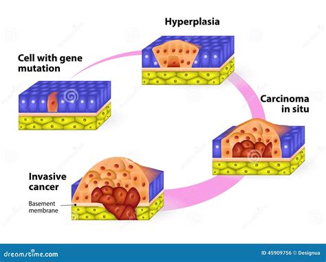 Developmental Phases Of Cancer Vector Illustration