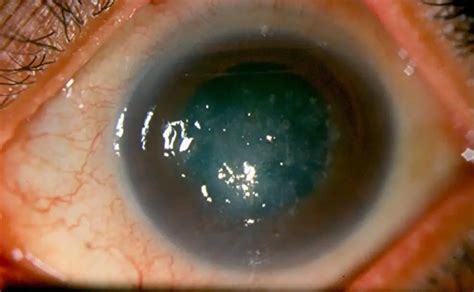 Fungal Keratitis Symptoms Treatment Photo Diseases And Conditions 2025