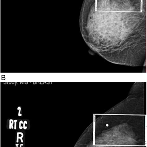 Us Right Breast And Axilla Showing 15 × 12 × 13 Mm Hypoechoic Solid
