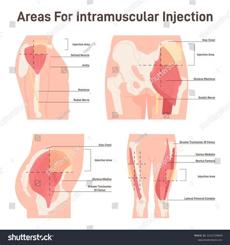 1 Hundred Intramuscular Injection Sites Royalty Free Images Stock