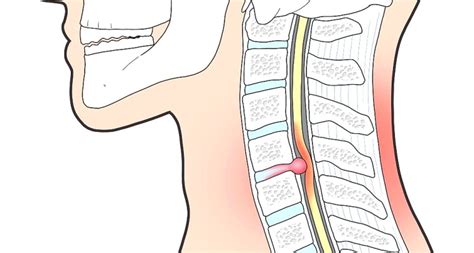 목디스크초기증상 운동 수술방법 원인따른 치료 정리하여 보기 네이버 블로그