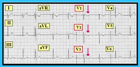 T Wave Inversion Meddic