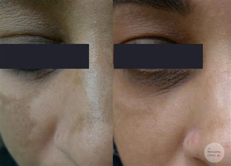 Melasma The Melasma Clinic