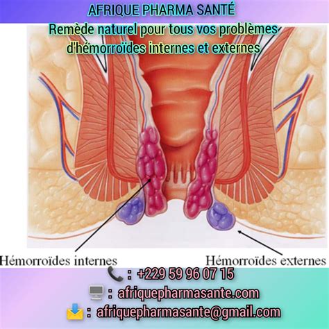 Comment Soigner Les Hémorroïdes Avec Un Traitement Bio Naturel