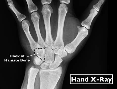 Hamate Bone Fracture Wolfarchitecture