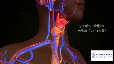 Hypothyroidism What Causes It Gluten Free Society