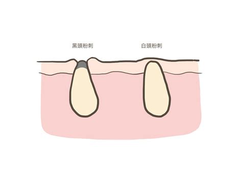 一次搞懂！毛孔粉刺完全攻略 Medpartner