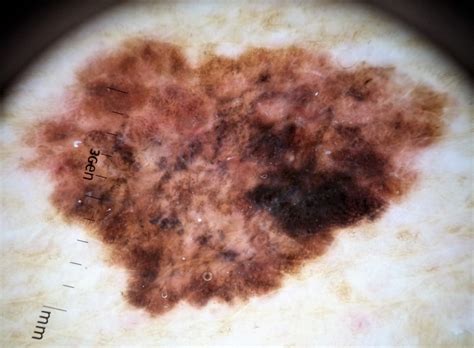 Dermoscopy Melanoma Skin Cancer Can Be Fatal Unless Caught Early But