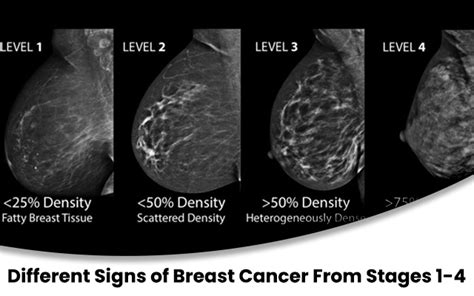 Different Signs Of Breast Cancer From Stages 1 4