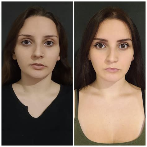 1 Day Before Surgery Vs 8 Months After Surgery R Jawsurgery