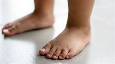 Dyshidrotic Eczema Feet