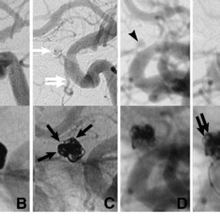 Coil Embolization Surveillance Angiography And Transition Of Coil Download Scientific Diagram