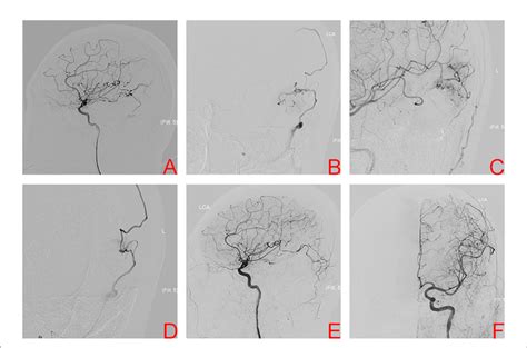 Figure Digital Subtraction Angiography Of Left Internal Carotid Artery Download Scientific