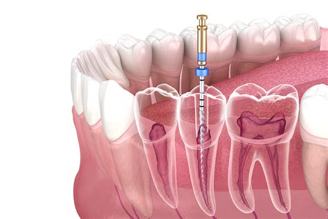 Root Canal Treatment Redone At Judith Robinson Blog