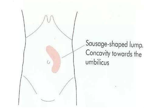 Intestinal Obstruction Ppt