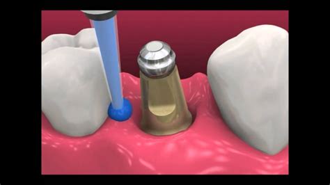 Dental Implant Procedure Youtube