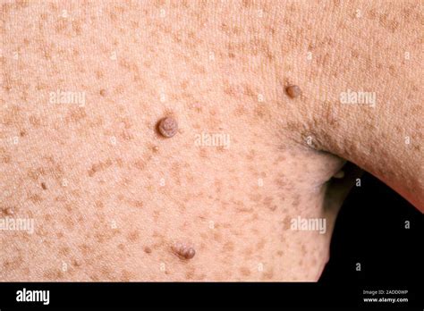Neurofibromatosis Neurofibroma Growths On The Skin Near An Armpit Of A