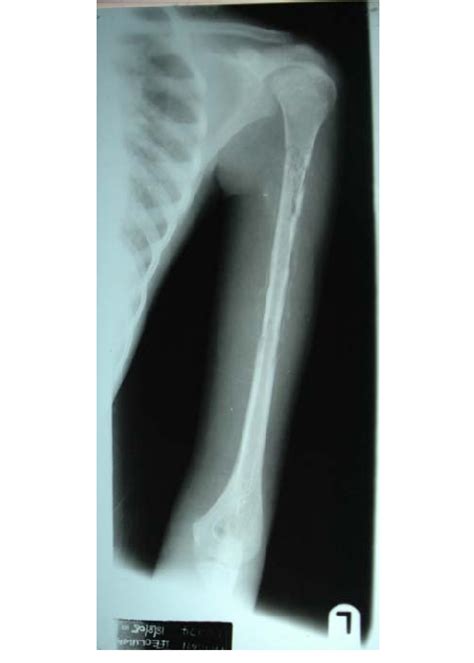 Pathologic Fracture Of Proximal Humerus Undisplaced From Chronic Download Scientific Diagram