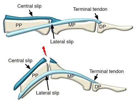 Central Slip Extensor Tendon Injury Wiki Sports Medicine Rorthopaedics