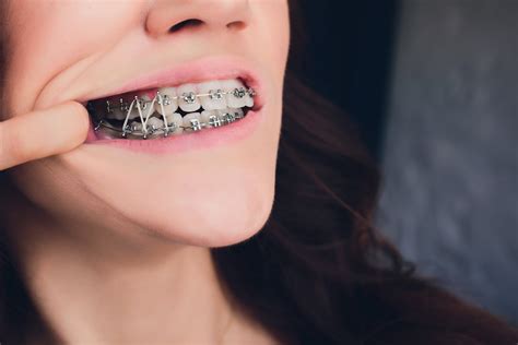 Traditional Braces Dr Soni