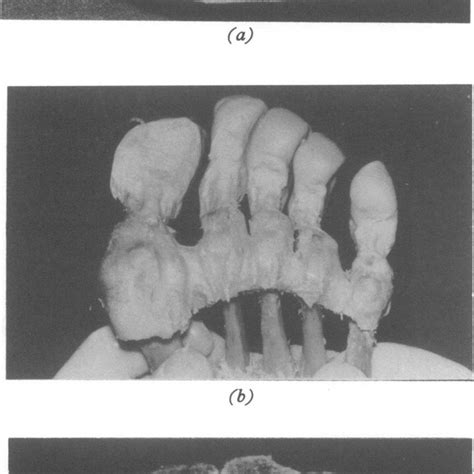A Dorsiflexion Of The Big Toe And The Windlass Effect Of The Plantar