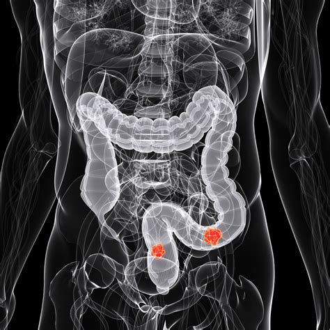 Colon Cancer Treatment Colonoscopy And Colorectal Cancer Screening