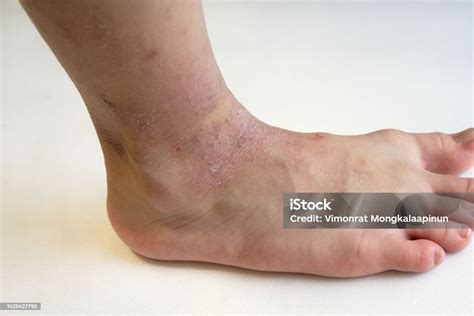 자연 채광에서 아시아 어린이의 오른쪽 발목에있는 알레르기 피부 아토피성 습진에 대한 스톡 사진 및 기타 이미지 아토피성 습진