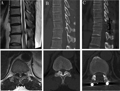 Preoperative Magnetic Resonance Imaging Signal Intensity Classification