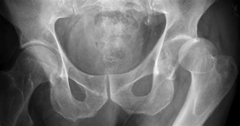 Hip Dislocation Midwest Orthopaedics