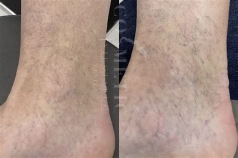 Asclera Vein Injections Sherman Oaks