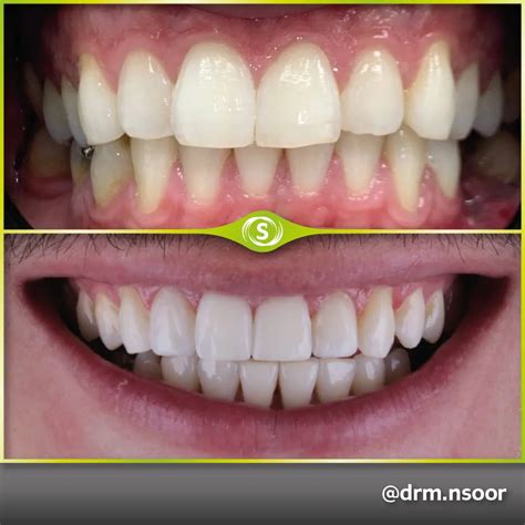 Before And After Teeth Straightening • Synergy Dental Clinic