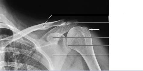 Shoulder Labeling Diagram Quizlet