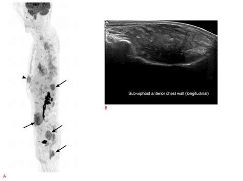 Myeloid Sarcoma In A 56 Year Old Man A Upon Positron Emission Tomography Imaging Multiple