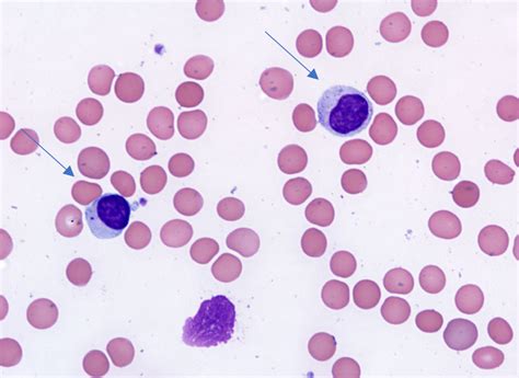 Uva Health Defines The Landscape Of Lgl Leukemia