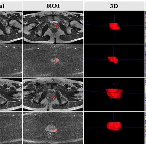 Preoperative MRI Images ROI Delineation And Pathological Comparison