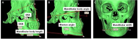 A Sna Snb And Mandibular Body Length B Mandibular Body And Download Scientific Diagram