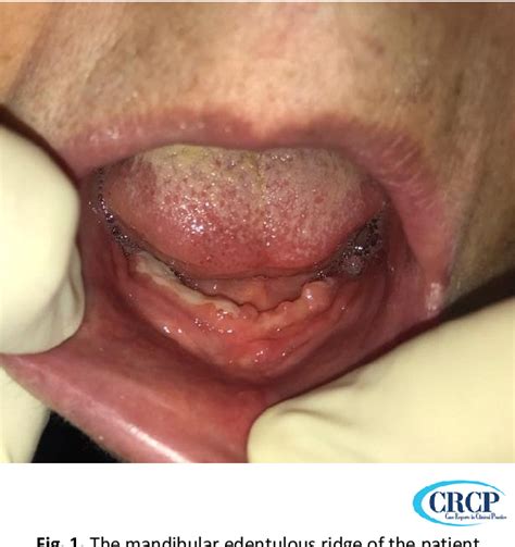 Figure 1 From A Diagnostic Challenge Of Methotrexate Induced Mucositis A Case Report Semantic