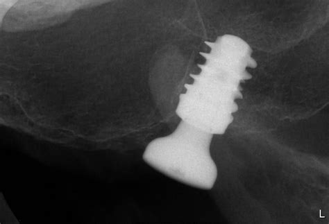 Maxillary Tuberosity Radiograph